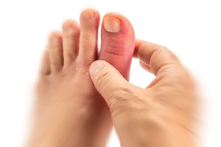 Guta: boala care afectează articulațiile și poate fi prevenită